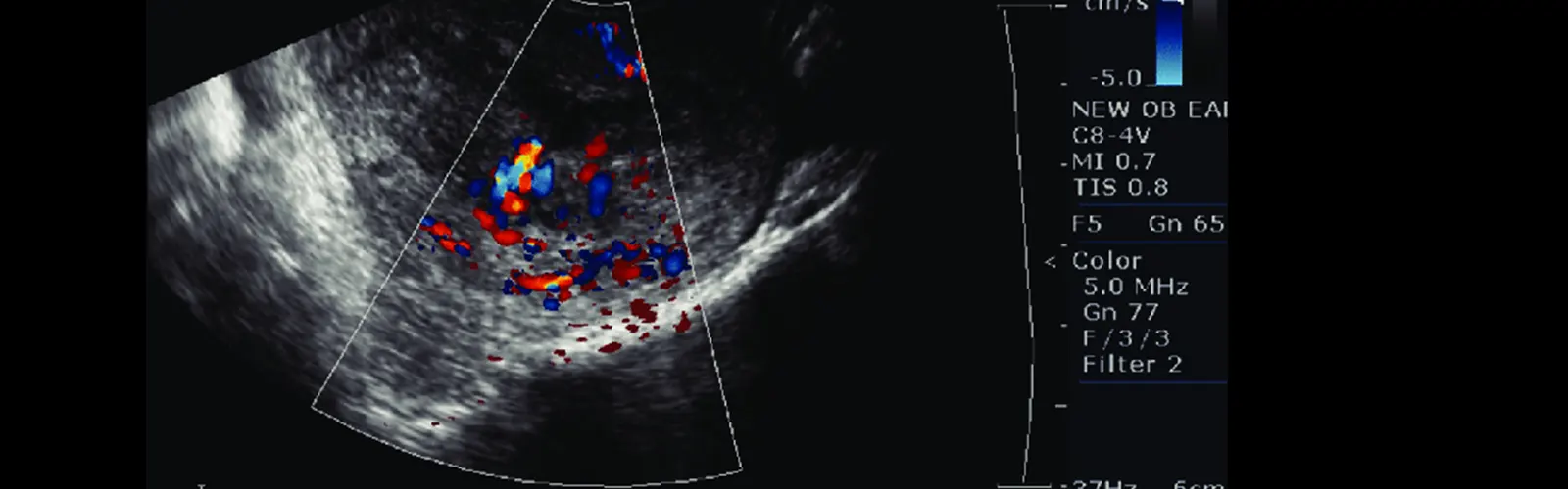 What is role of Pelvis Color Doppler Ultrasound?