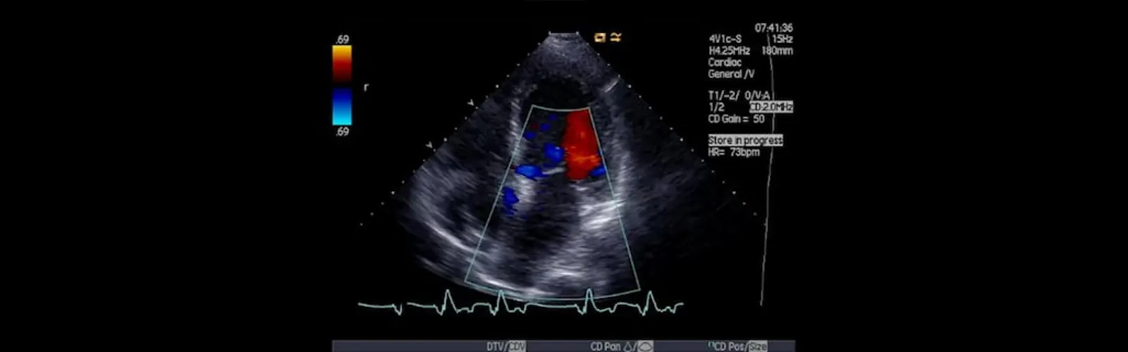 What are the Benefits of Abdominal Ultrasound with Color Doppler?