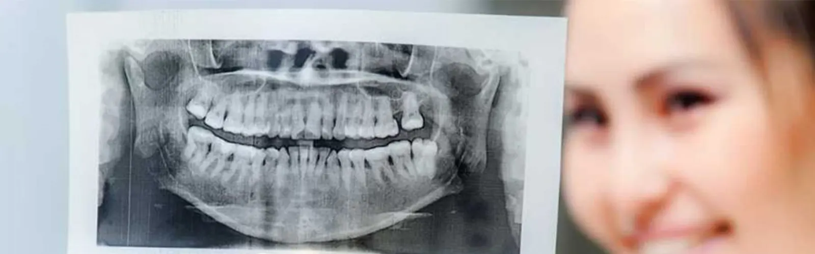 Why is an OPG Scan Done?