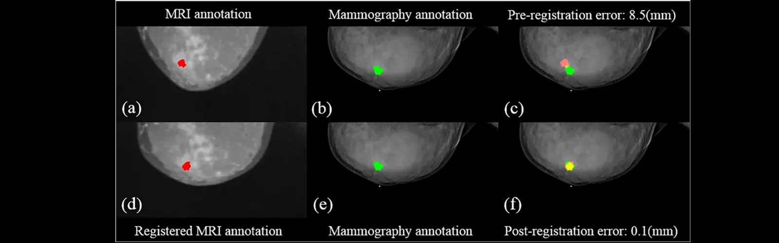 What Is The Role Of Mammography In The Breast Disease? | Ganesh Diagnostic