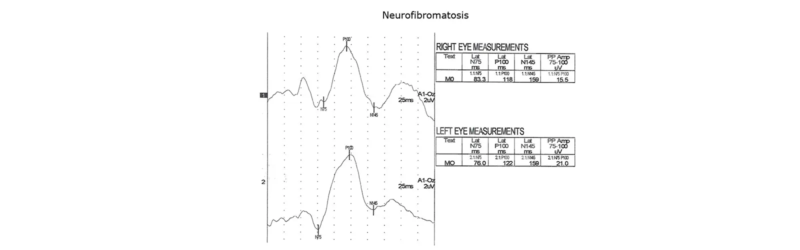 How Long Does The (Bera) Brainstem Evoked Response Test Take? | Ganesh ...