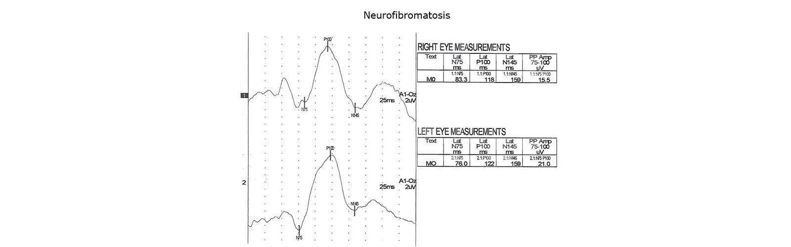 How Much Time Does It Take To Prepare VEP Report? | Ganesh Diagnostic