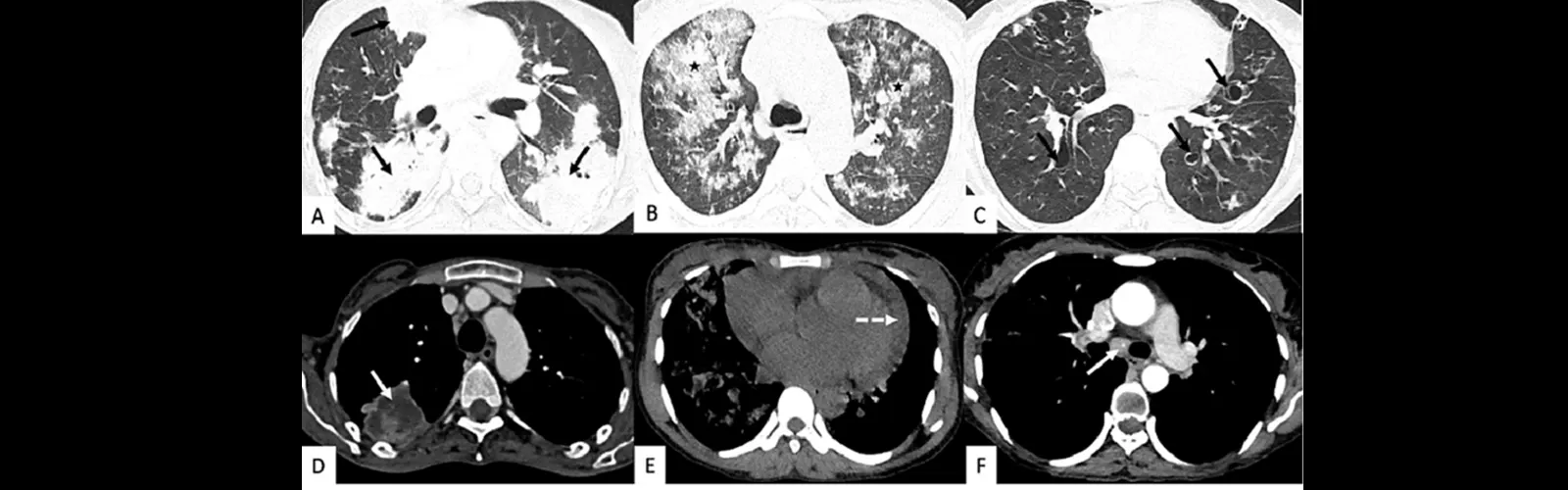 What Do Reports of NCCT Chest Show?