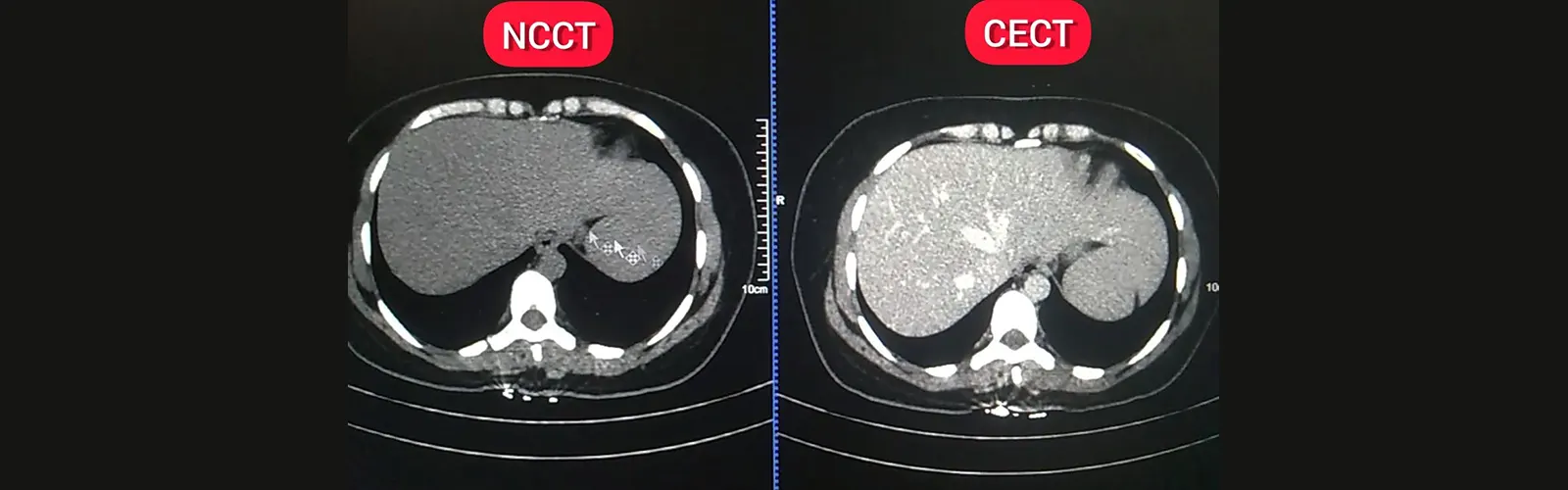 How To Prepare For NCCT Abdomen? | Ganesh Diagnostic