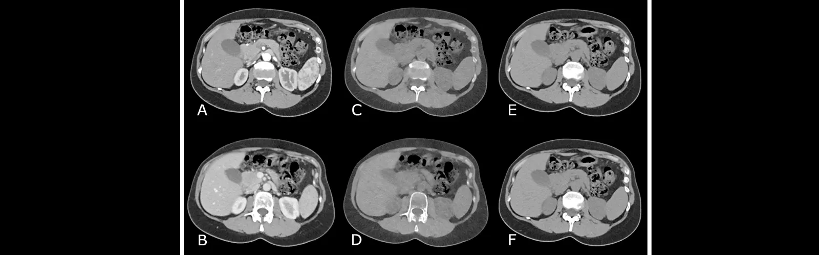 What Is The Role Of NCCT Abdomen In Cancer Detection? | Ganesh Diagnostic