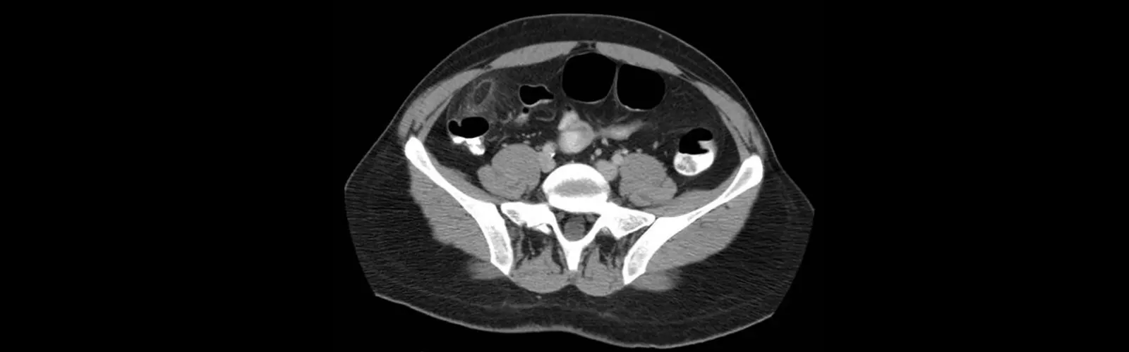 What Is The Procedure Of NCCT Whole Abdomen? | Ganesh Diagnostic