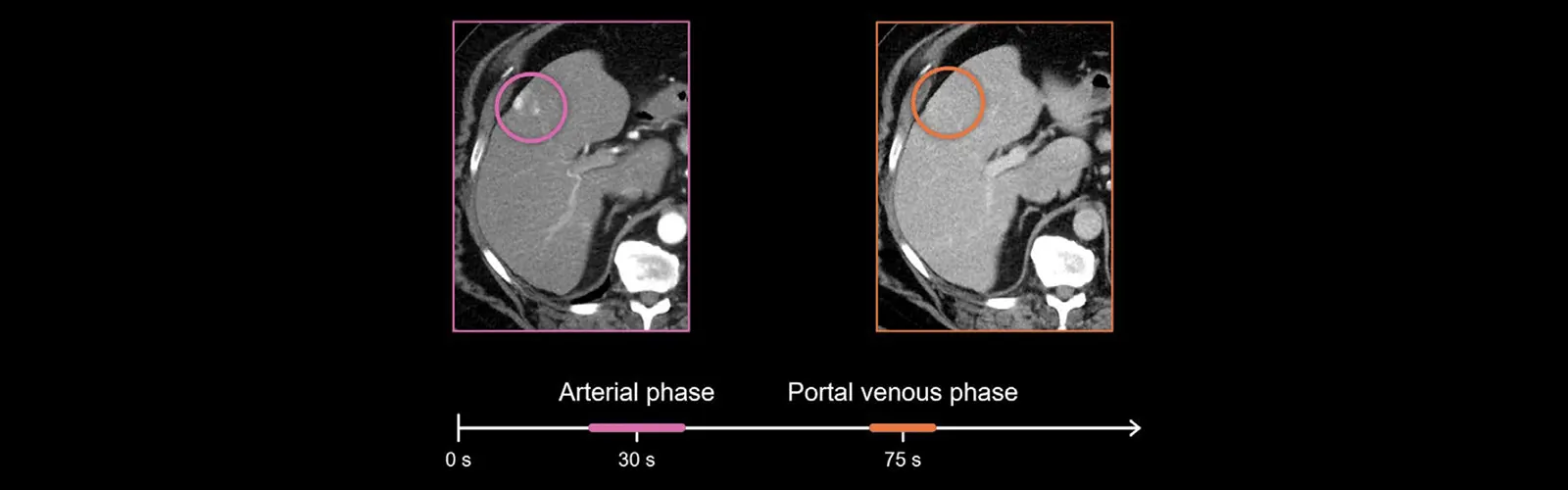 What Is The Role Of NCCT Whole Abdomen In Staging Of Cancer? | Ganesh ...