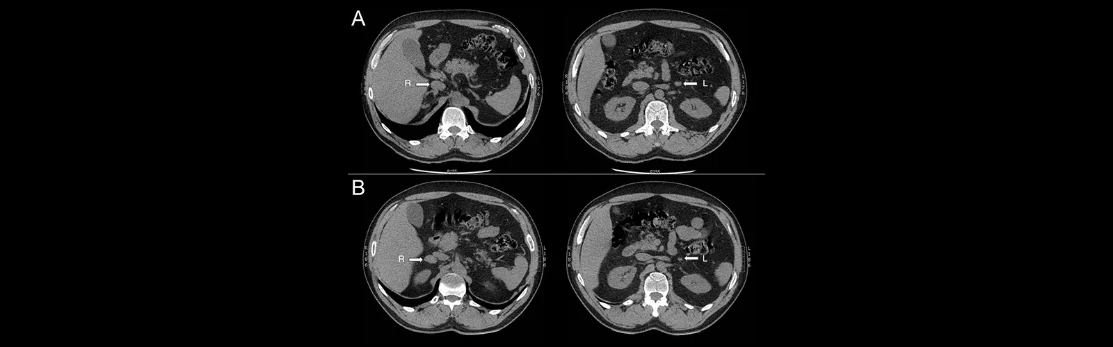 What Is The Role Of NCCT Whole Abdomen In Follow up Of Patients ...