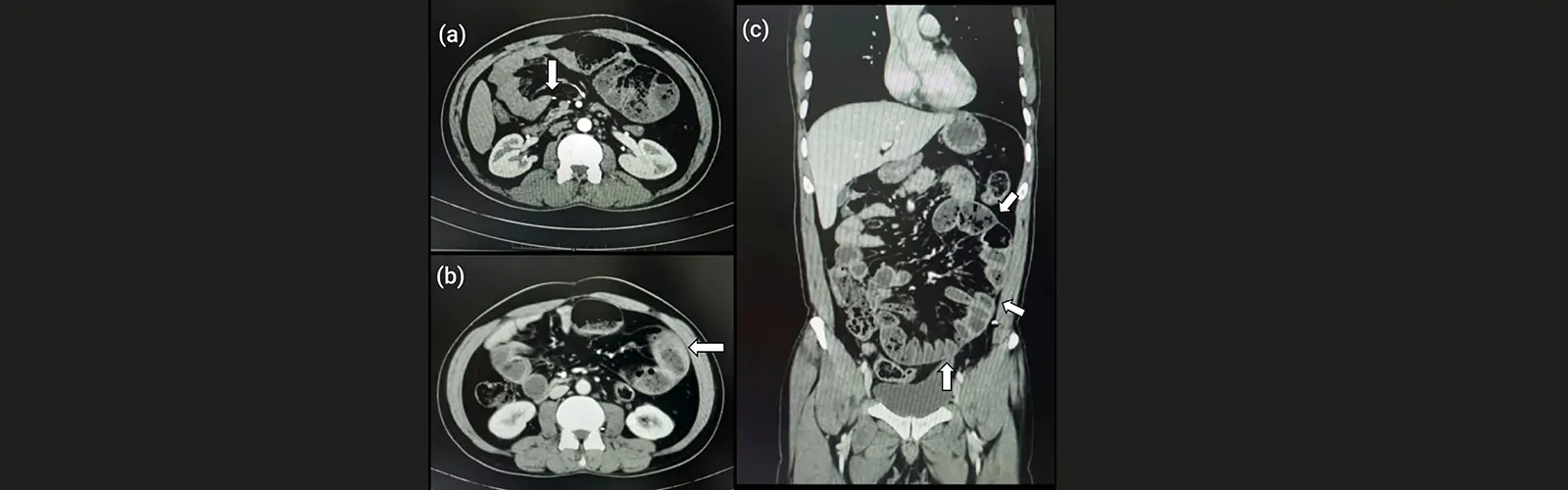 What Is CECT Whole Abdomen? Procedure Benefits and More | Ganesh Diagnostic