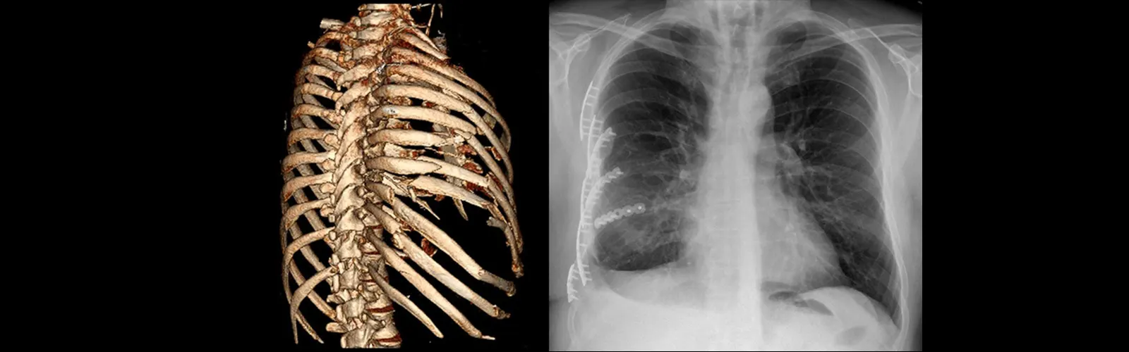 Why Is CT Chest 3D Done? | Ganesh Diagnostic