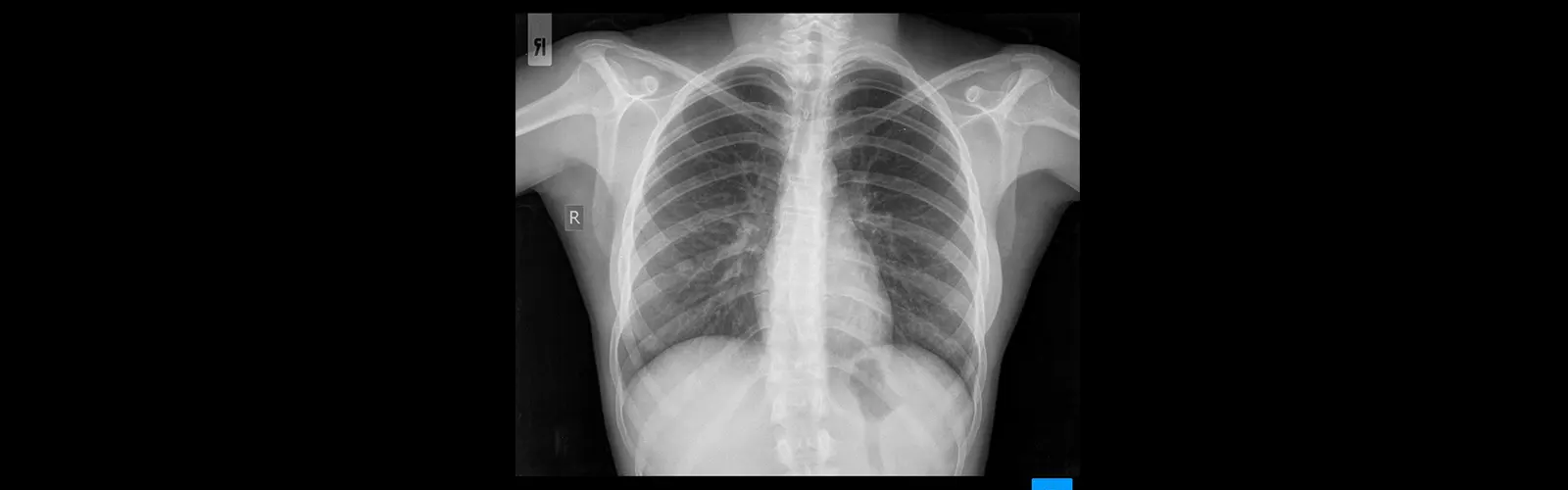 What Are The Advantages Of Using 3D Imaging For CT Chest Scan? | Ganesh ...