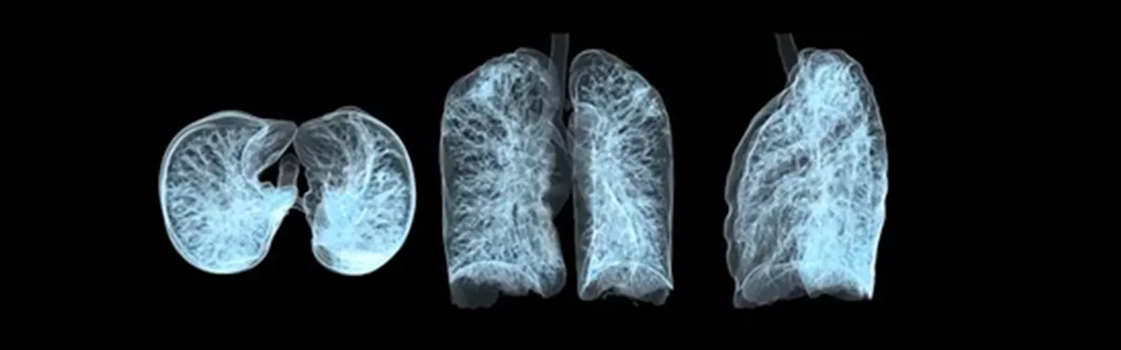 What Is The Role Of CT Chest 3D In The Follow up Of Patients? | Ganesh ...