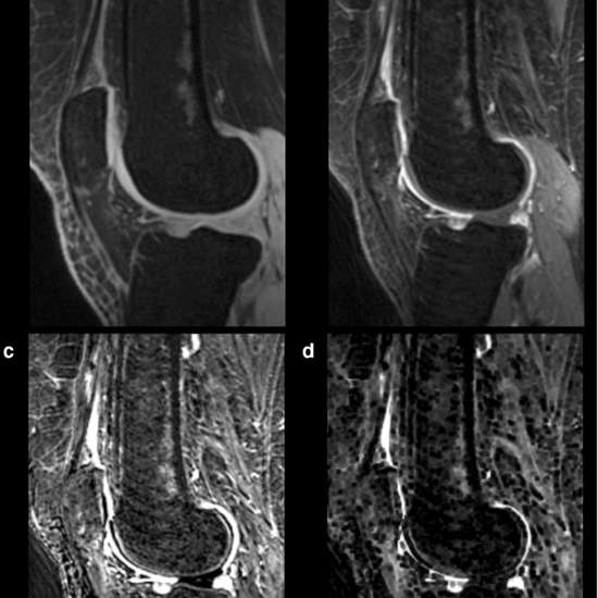 What Is Knee MRI? Reasons To Choose MRI Over X-Ray Scan | Ganesh Diagnostic