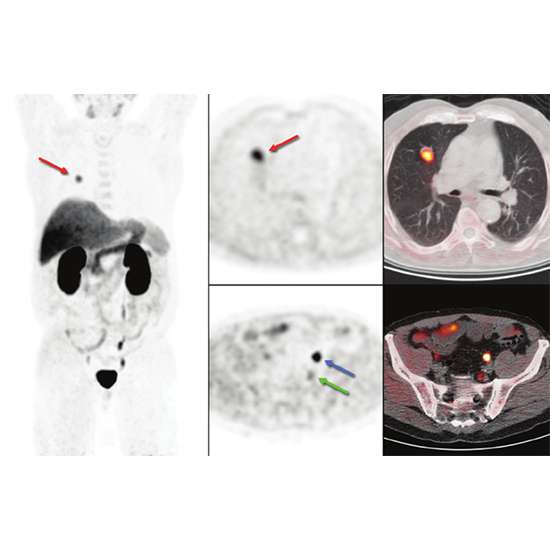 F-18 Choline PET Scan : What Is It, Uses, Preparation and Results Side ...