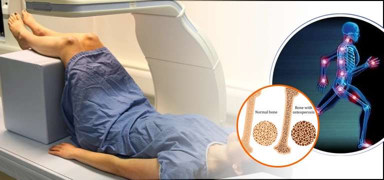 Everything you need to know about Bone Mass Density, Bone Density ...