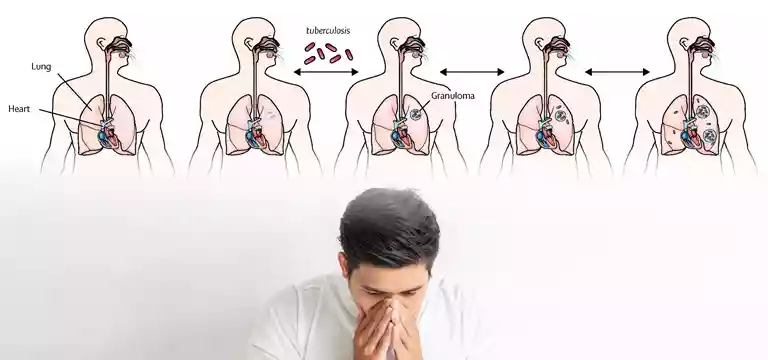 Understanding the Latent Tuberculosis Stage: Diagnosis, Symptoms, and ...