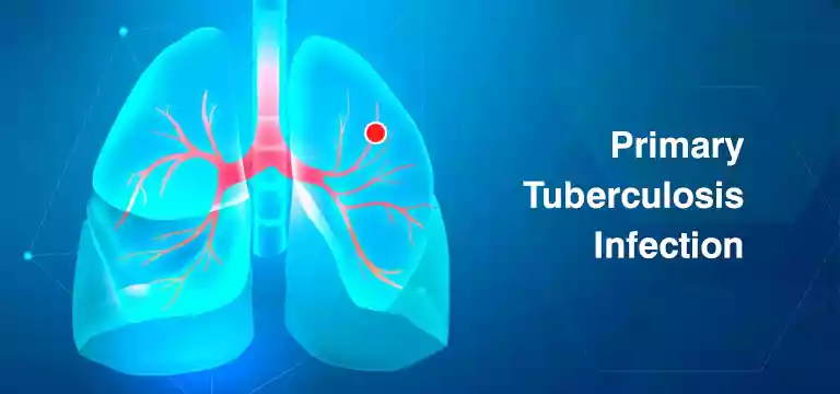 Primary Tuberculosis Infection: Signs, Diagnosis, and Treatment