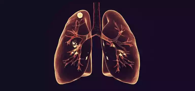 Secondary Tuberculosis Infection: Causes, Symptoms, Diagnosis, and ...