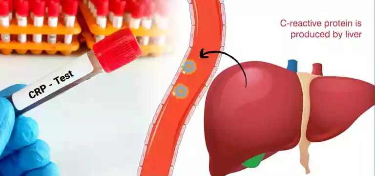 A Complete Guide Regarding CRP Test Procedure, Uses and Cost | Ganesh ...