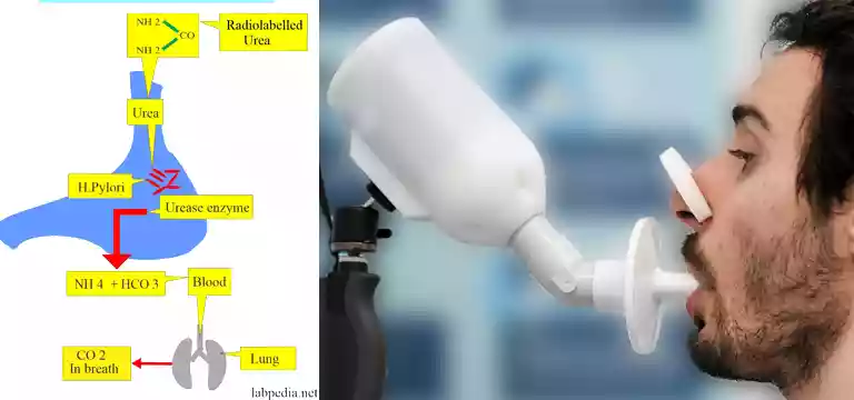 Urea breath test price in Delhi