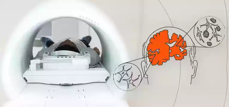 Understanding PET Scans in Alzheimer's Disease: Early Detection and ...