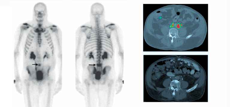 A PET Scan in Bone Disorders: Symptoms, Causes, Diagnosis and Treatment