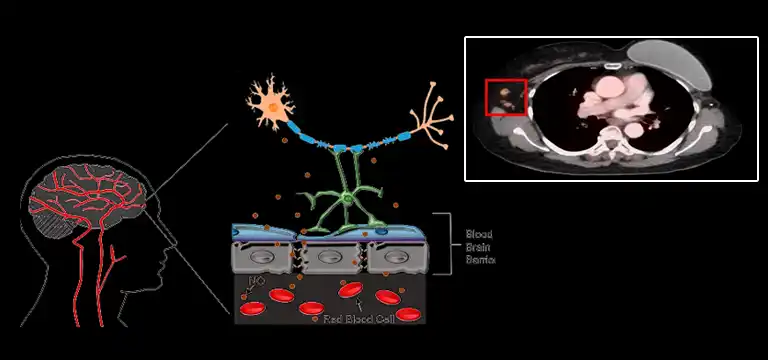 Everything About What Hypermetabolic Activity Mean on PET Scan?