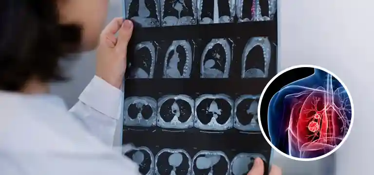 Importance of PET Scan for Lung Cancer | Ganesh Diagnostic