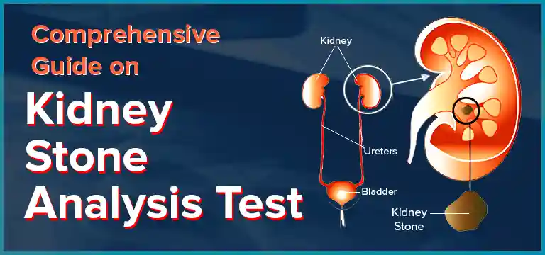 Comprehensive Guide on Kidney Stone Analysis Test | Ganesh Diagnostic