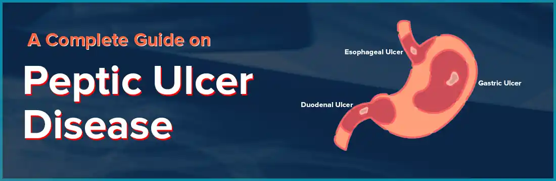 A Complete Guide on Peptic Ulcer Disease | Ganesh Diagnostic