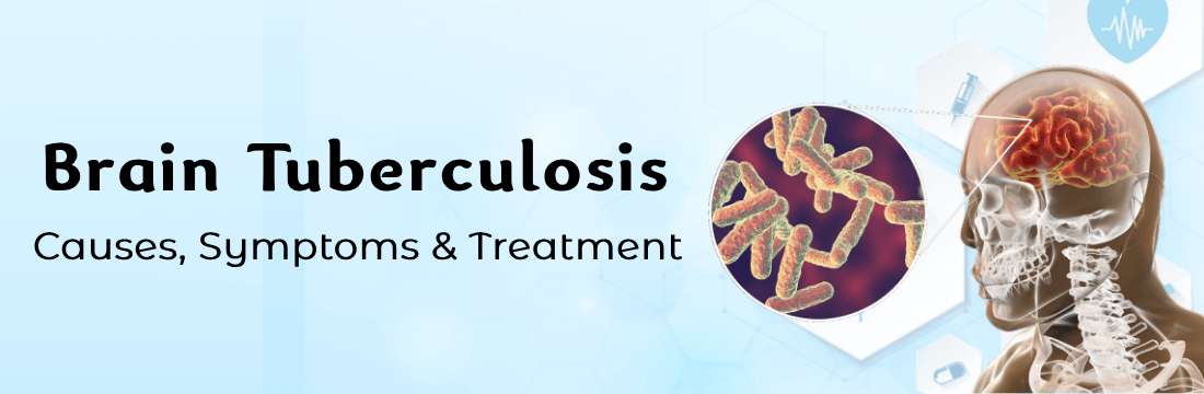 Brain Tuberculosis : Symptoms, Risk Factors, Causes and Treatment