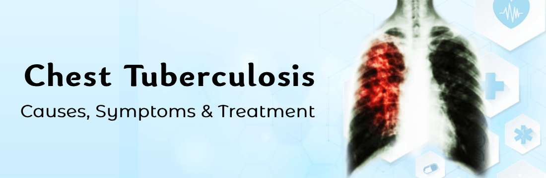 Unmasking TB Chest: Causes, Symptoms and Treatment