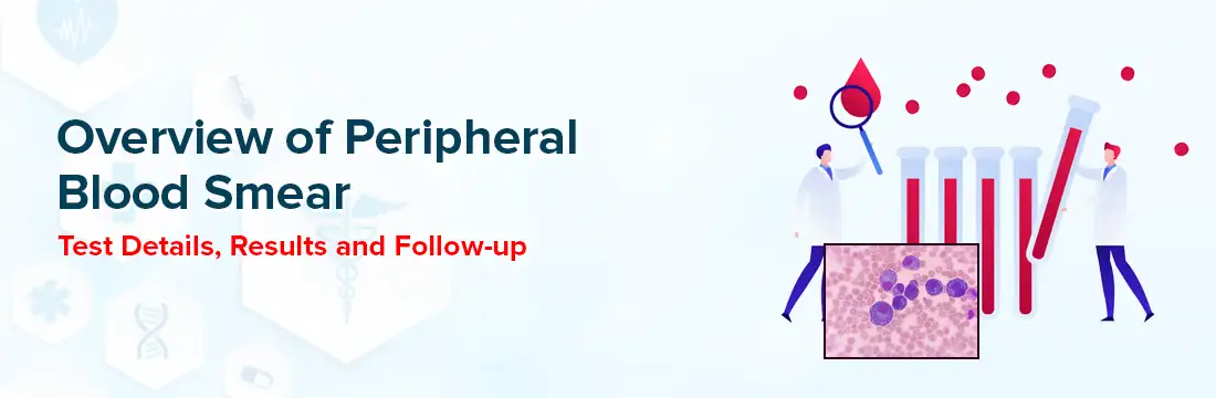 Overview Of Peripheral Blood Smear: Test Details, Results and Follow-up ...