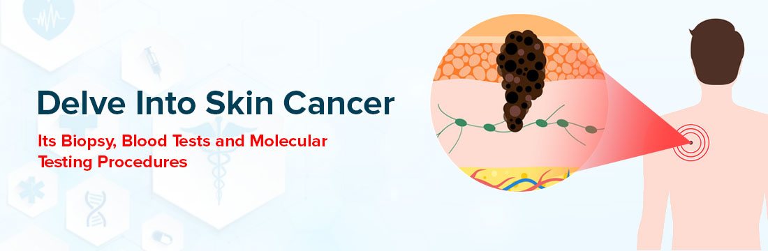 Delve Into Skin Cancer: Its Biopsy, Blood Tests and Molecular Testing ...