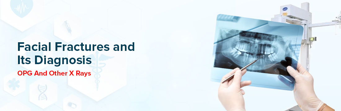 Facial Fractures and Its Diagnosis, OPG, CT and Other X Rays