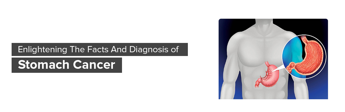 Facts and Diagnosis of Stomach Cancer | Causes, Symptoms of Stomach Cancer
