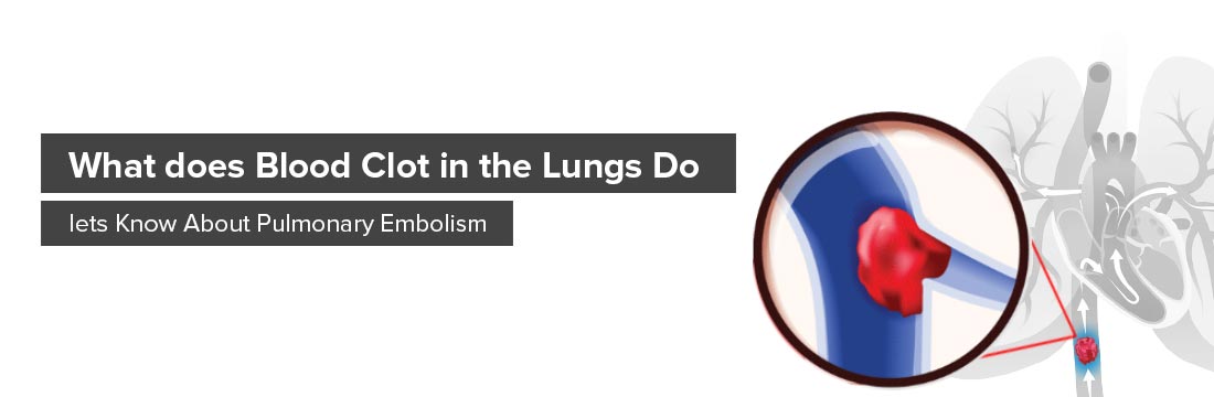 What Does Blood Clot in the Lungs Do? Know About Pulmonary Embolism
