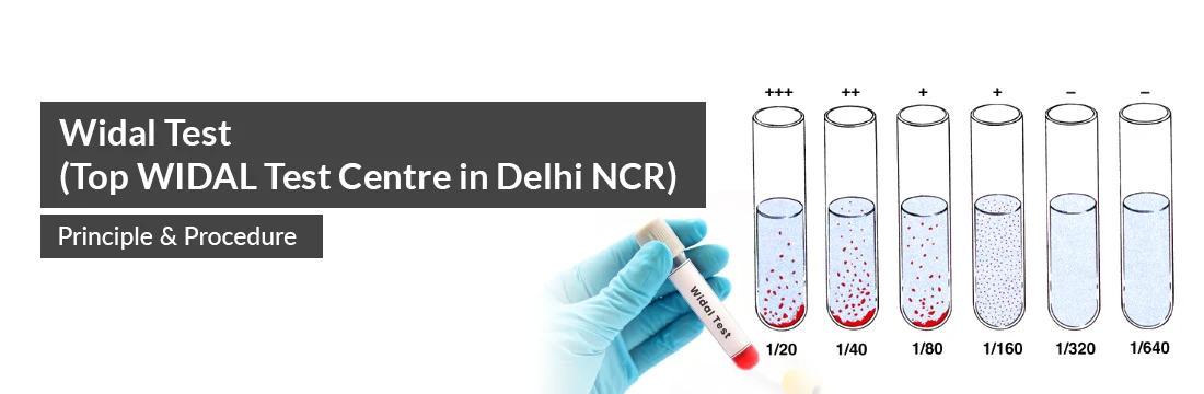 Widal Test (Top WIDAL test centre in Delhi NCR) | Principle & Procedure