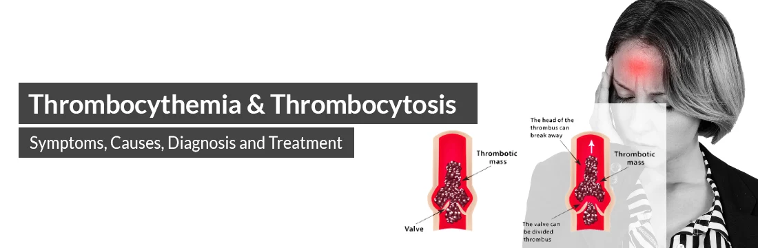 Thrombocythemia & Thrombocytosis: Symptoms, Causes, Diagnosis and Treatment