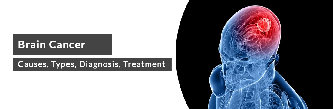 Brain Cancer: Causes, Types, Diagnosis, Treatment, Prevention and Cost