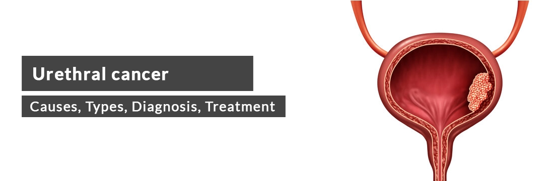 Urethral cancer: Causes, Types, Diagnosis, Treatment, Prevention and Cost