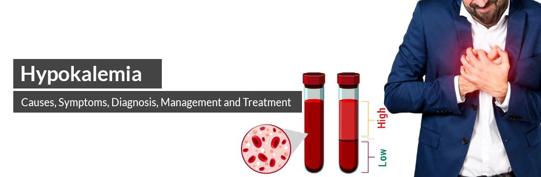 Hypokalemia: Causes, Symptoms, Diagnosis, Management and Treatment