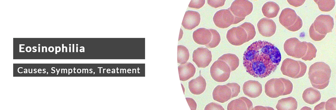 Eosinophilia: Causes, Symptoms, Treatment, and Its Range