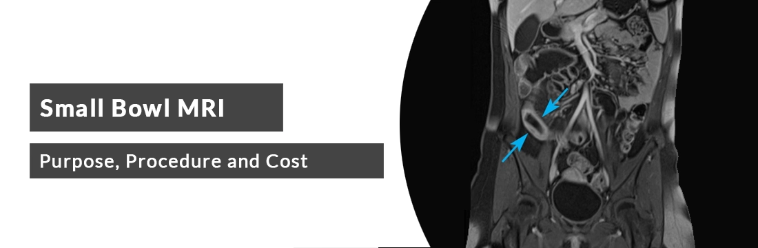 Small Bowl MRI: Purpose, Procedure, Cost and Best Mri Centre in Delhi