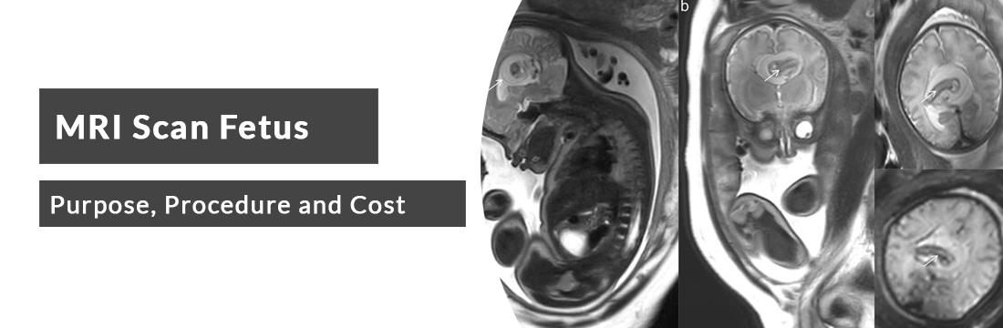 MRI Scan Fetus: Purpose, Procedure, Cost and Best MRI Centre in Delhi