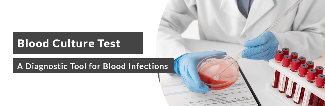 Blood Culture Test: A Diagnostic Tool for Blood Infection