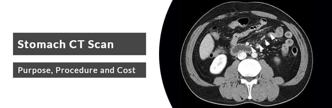 Stomach CT Scan: Purpose, Procedure, Cost in Delhi/ Noida/ NCR