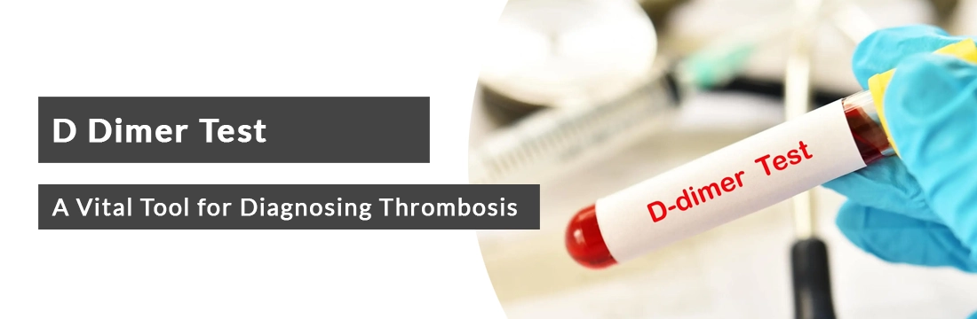 D Dimer Test- A Vital Tool for Diagnosing Thrombosis