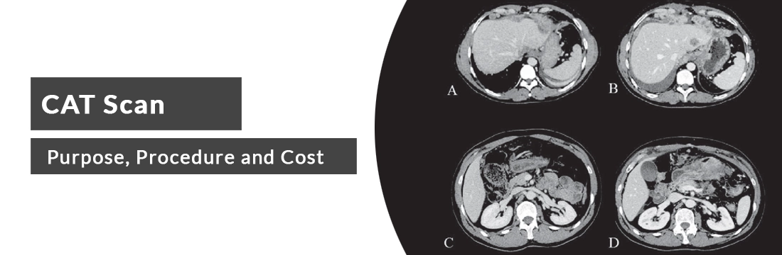 CAT Scan: Purpose, Procedure, Cost in Delhi/ Noida/ NCR