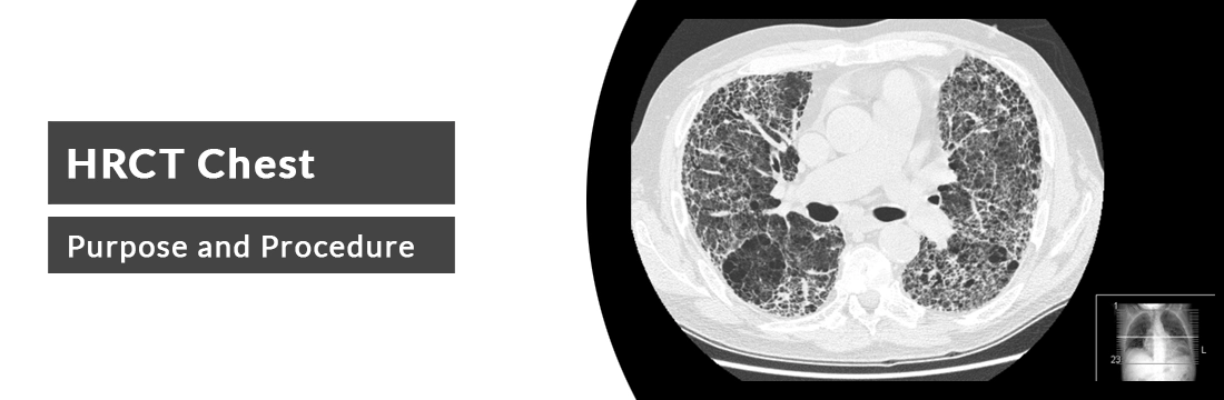 HRCT Chest: Purpose and Procedure | Ganesh Diagnostic